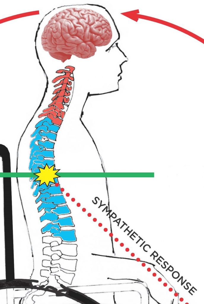 Autonomic Dysreflexia - National Rehabilitation Hospital